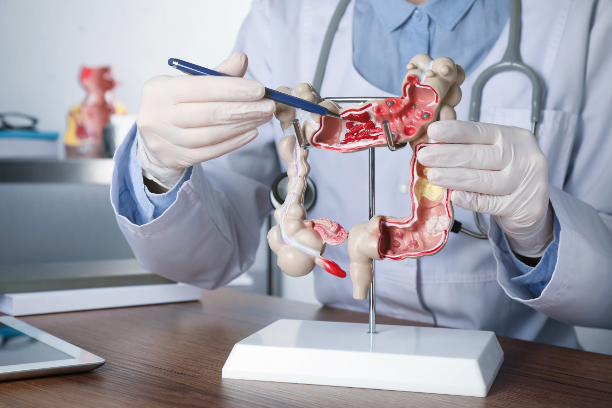 Cancer colorectal : signes, prévention et traitements à connaître - Doqi.fr