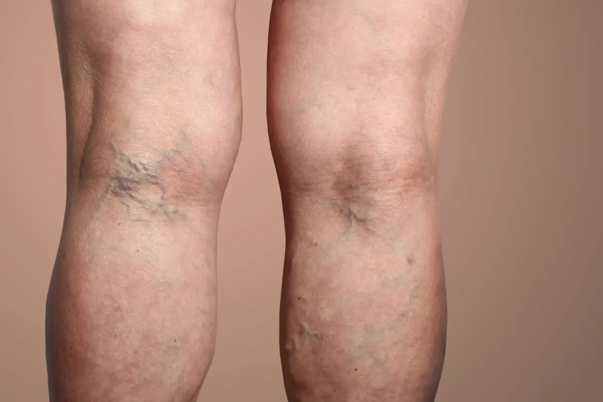 Varices : pourquoi elles apparaissent et comment les traiter efficacement - Doqi.fr